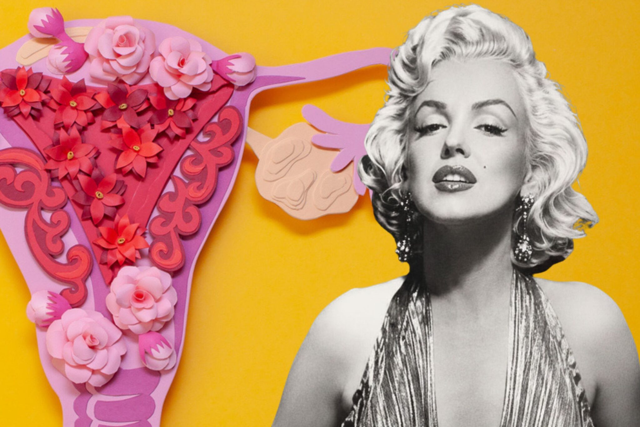 Endometriosis and Infertility: Lessons from Marilyn Monroe
